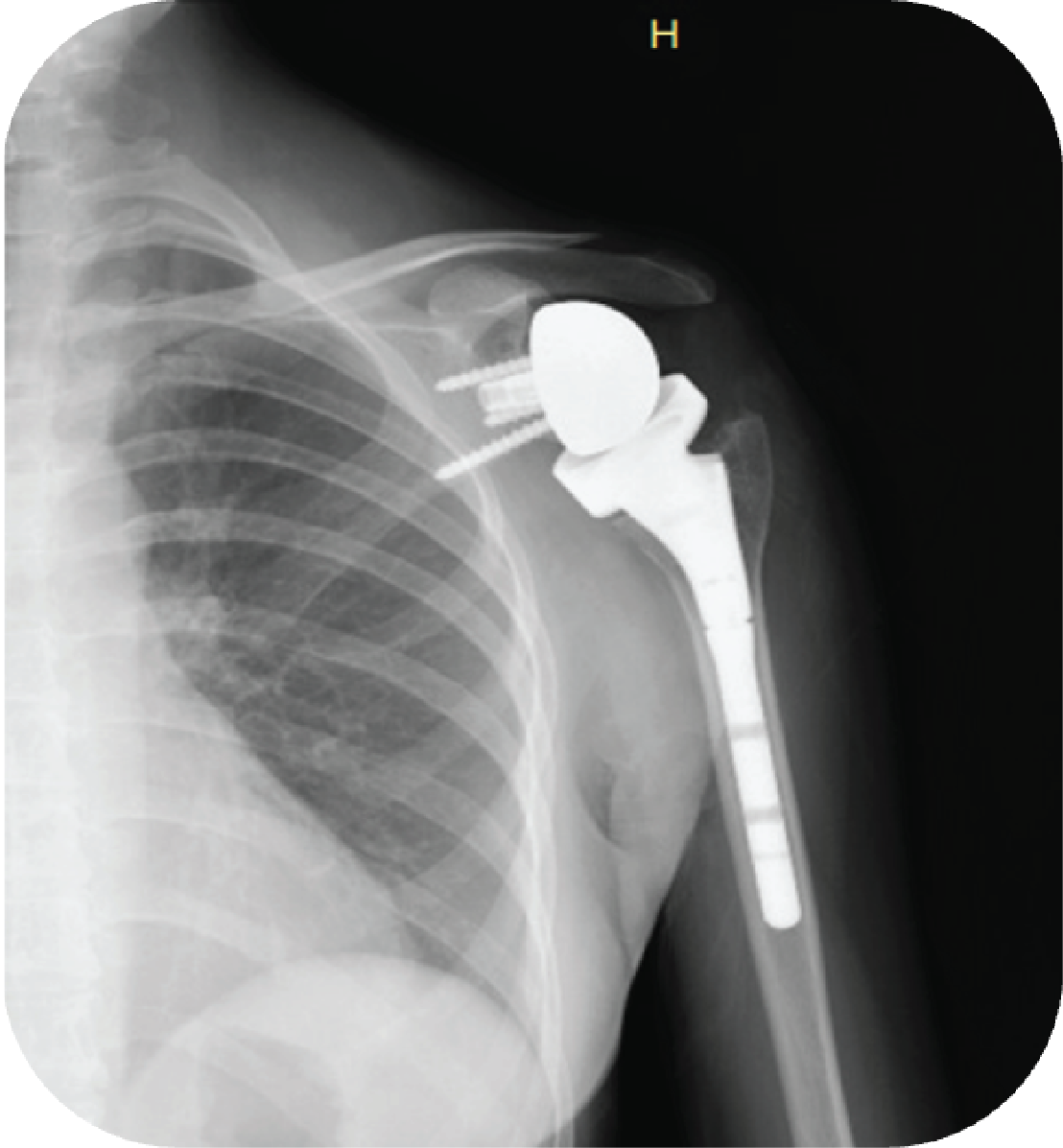 Klinik Çalışmalar - BLOOCELL® | Bone & Cartilage Repair Matrix